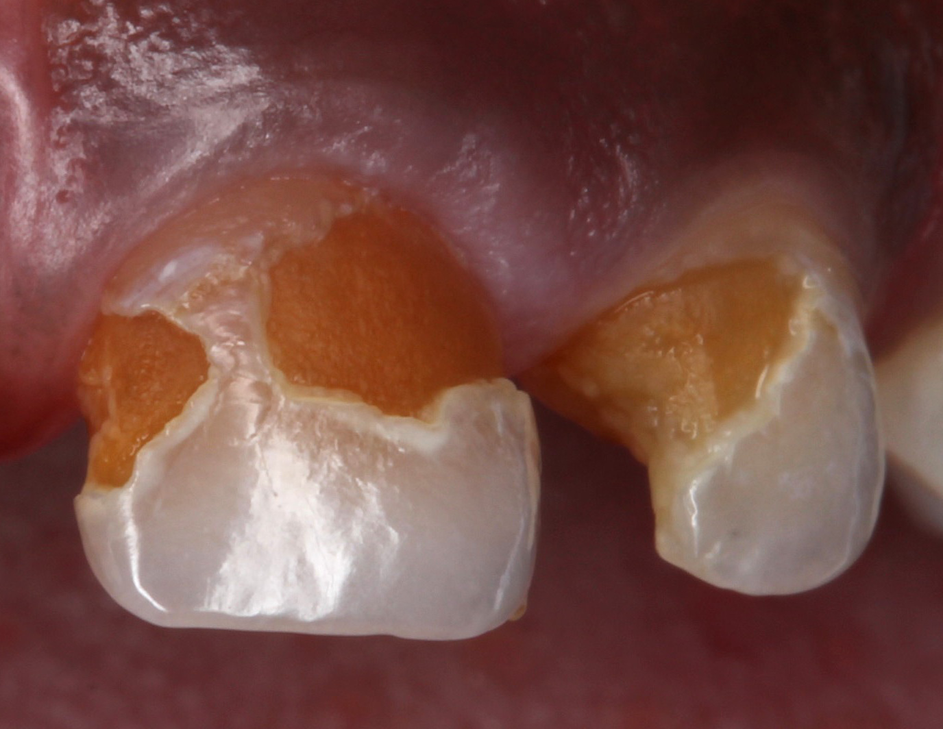 Karies Foto & Bild | kinder, gesundheit, mund Bilder auf fotocommunity