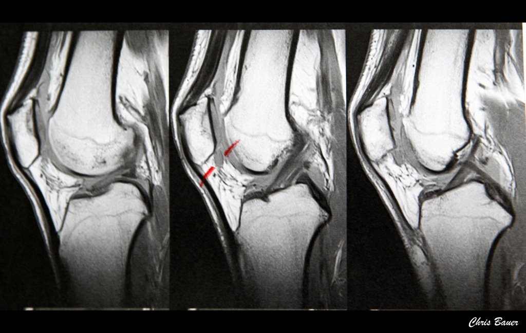 Patellaluxation Foto & Bild | reportage dokumentation, medizinische ...