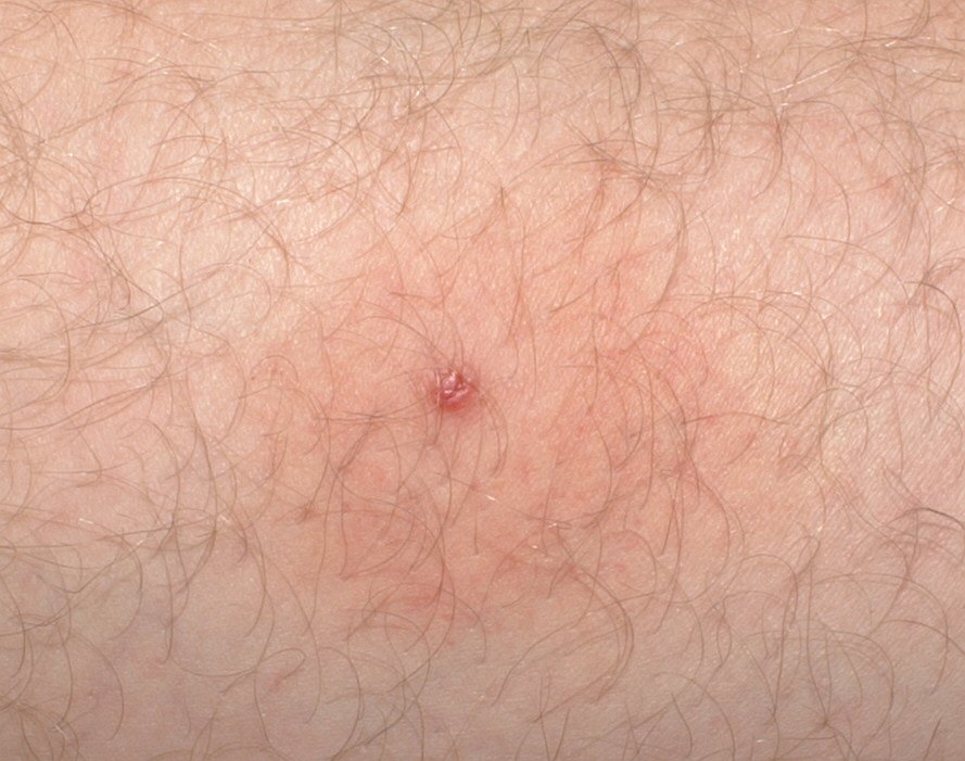 Redness And Tick Bite Marks On The Skin Stock Photo Download Image Now ... Redness And Tick Bite Marks On The Skin Stock Photo Download Image Now ...
